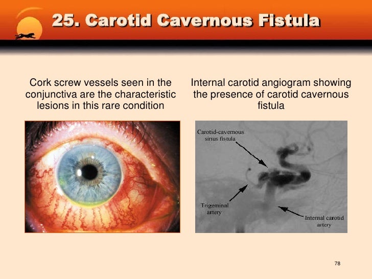 Quiz 25 On Ophthalmoplegia