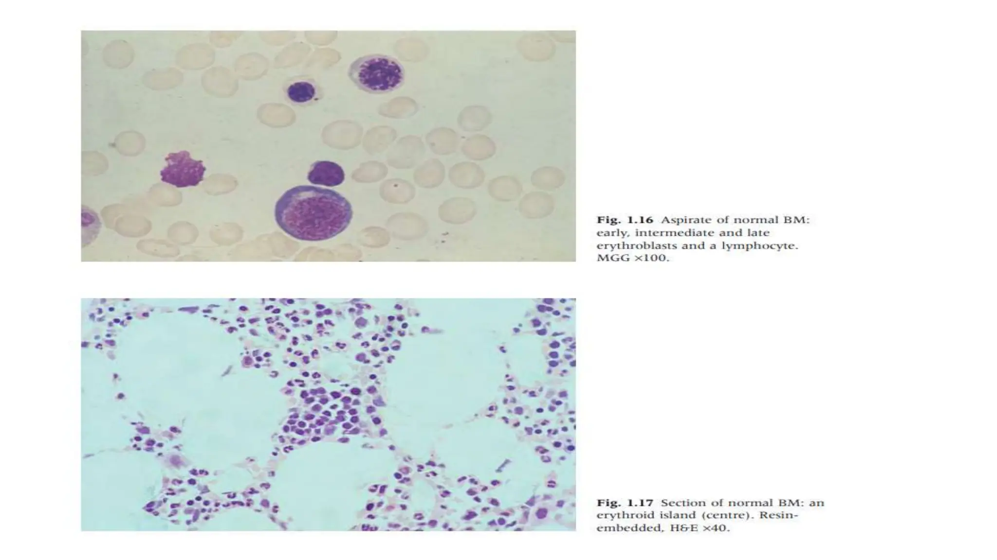 QUIZ ON BONE MARROW-MICROCYTIC + APLASTIC.pptx