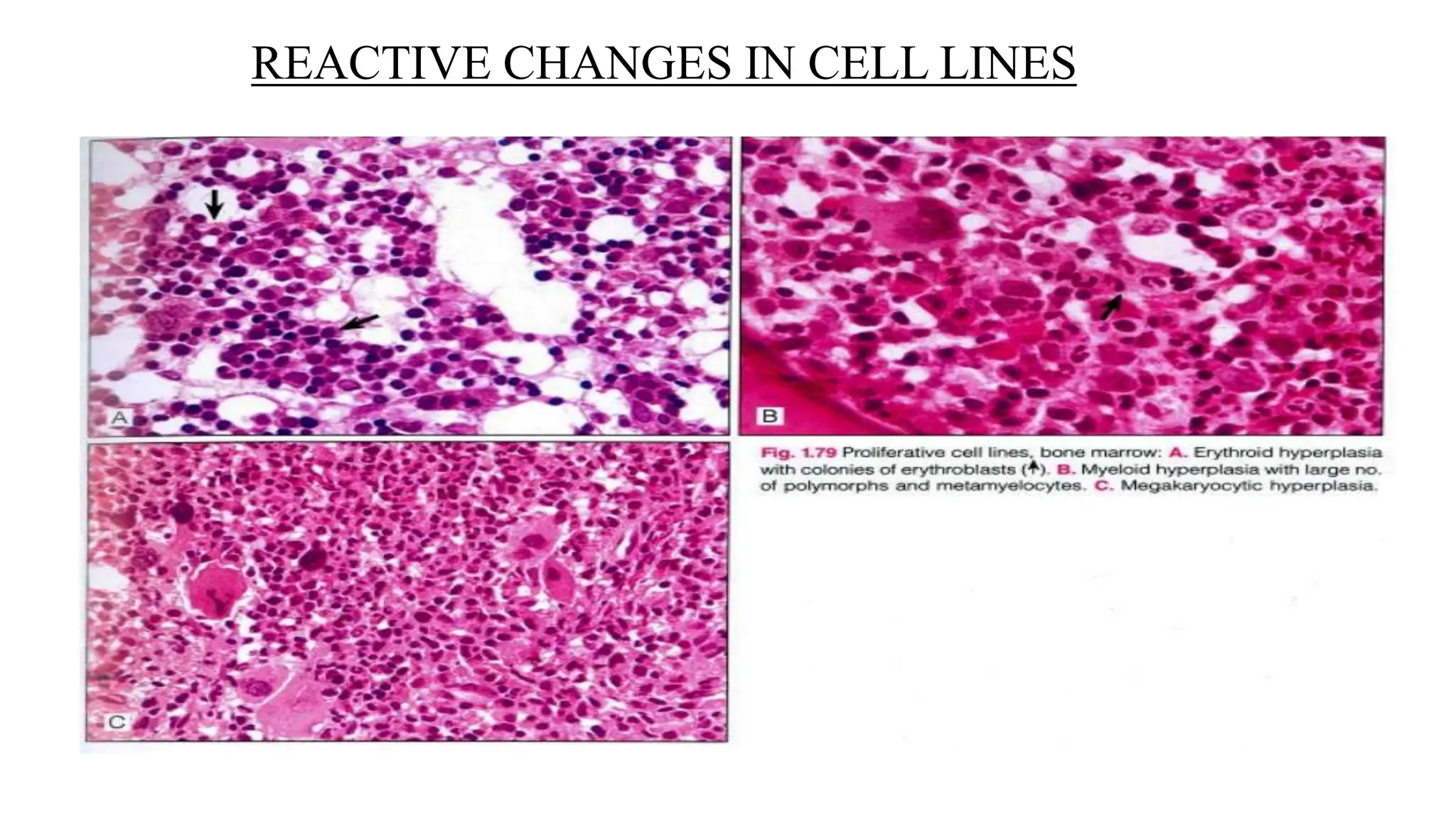 QUIZ ON BONE MARROW-MICROCYTIC + APLASTIC.pptx