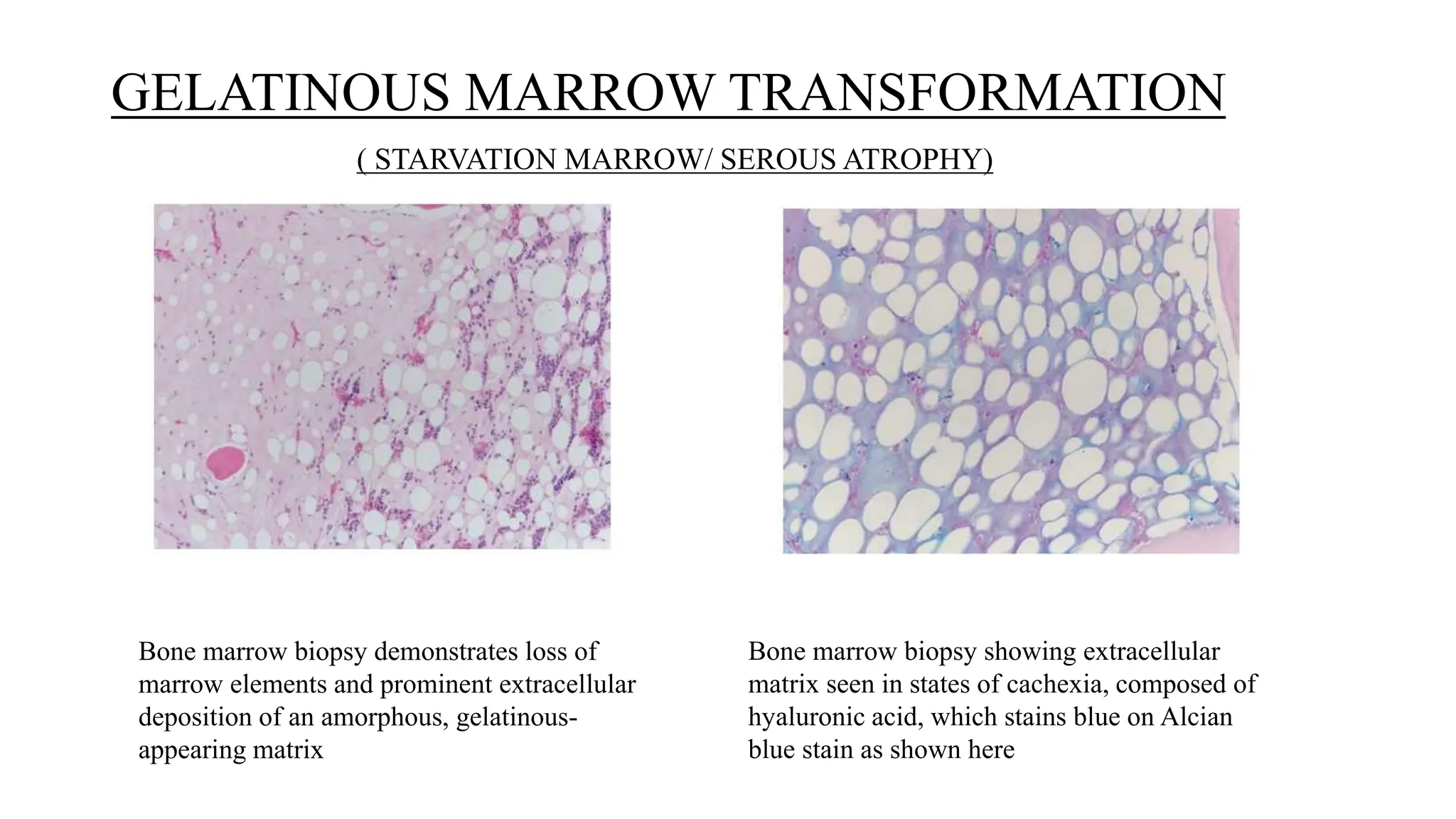 QUIZ ON BONE MARROW-MICROCYTIC + APLASTIC.pptx