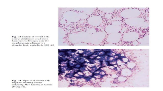 QUIZ ON BONE MARROW-MICROCYTIC + APLASTIC.pptx