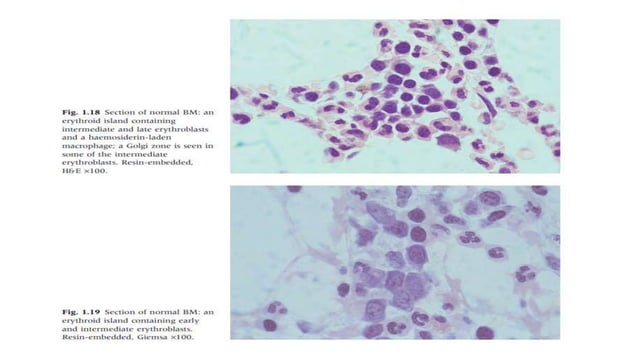 QUIZ ON BONE MARROW-MICROCYTIC + APLASTIC.pptx