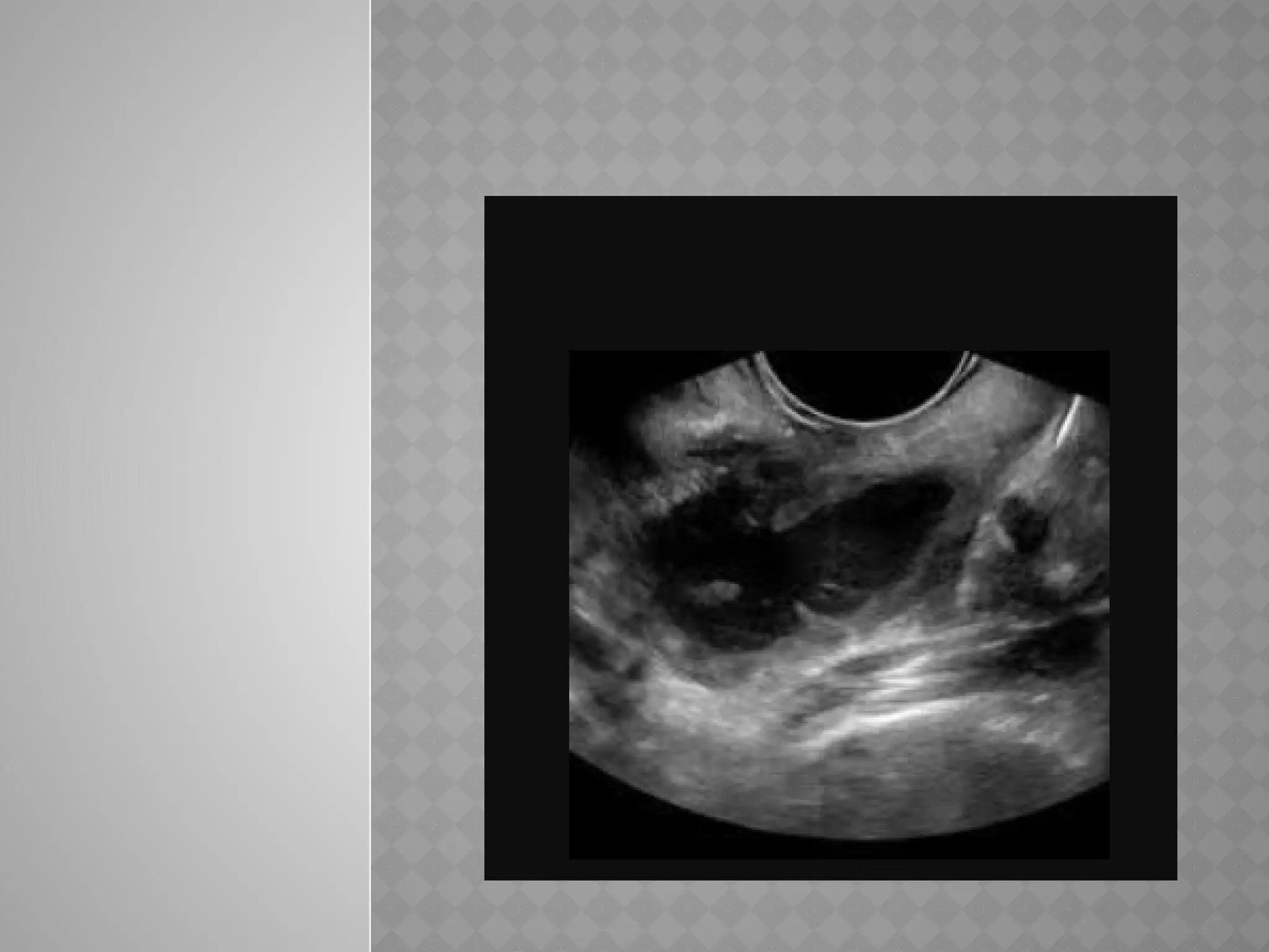 QUNISY - TONSILLAR ABSCESS ON ULTRASOUND | PPTX
