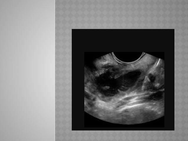 QUNISY - TONSILLAR ABSCESS ON ULTRASOUND | PPTX