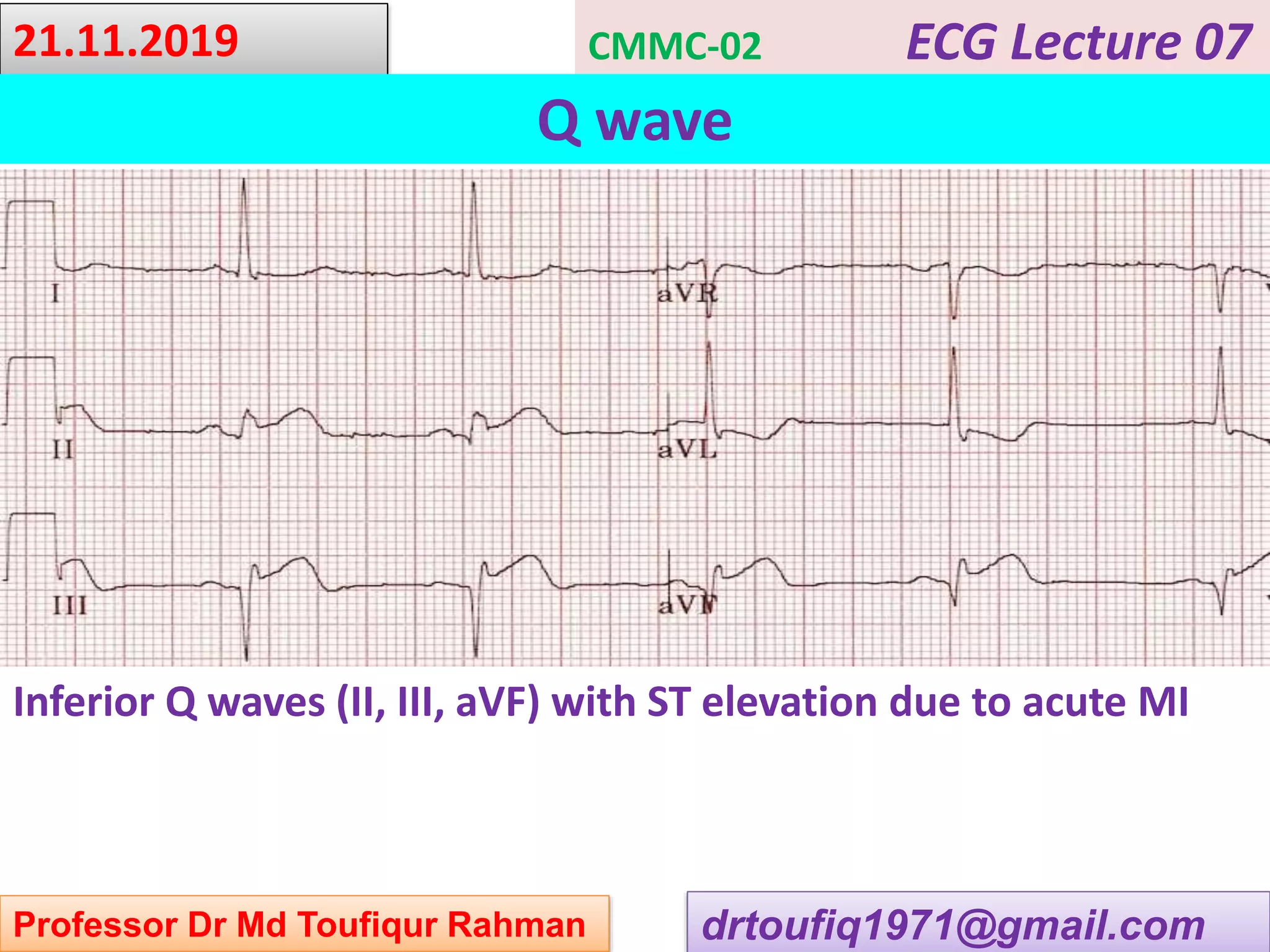 ECG-Q wave | PPT