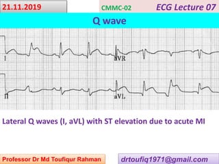 ECG-Q wave | PPT