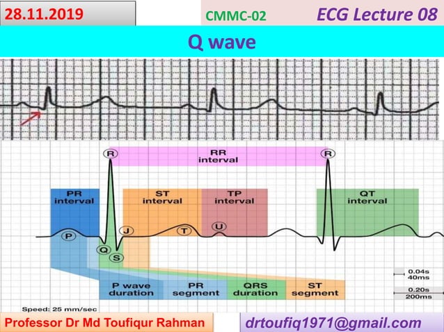 ECG-Q wave | PPT