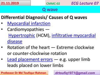 ECG-Q wave | PPT
