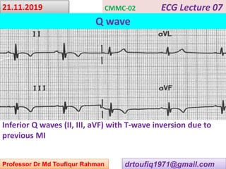 ECG-Q wave | PPT