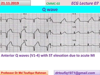 Q Wave Formation