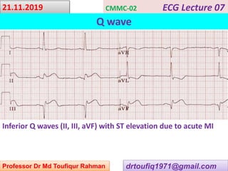 Q Wave Formation
