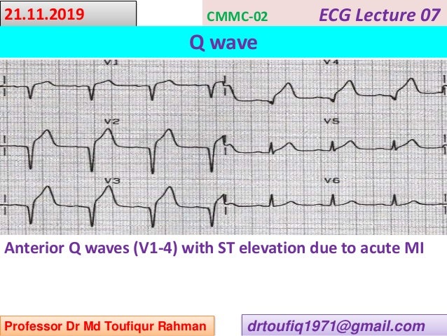 ECG-Q wave