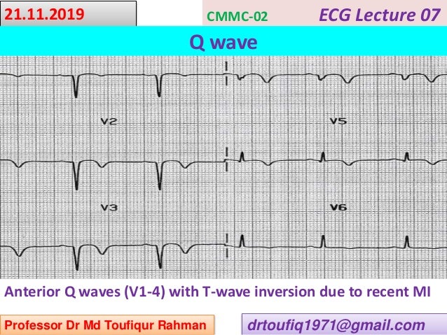 ECG-Q wave