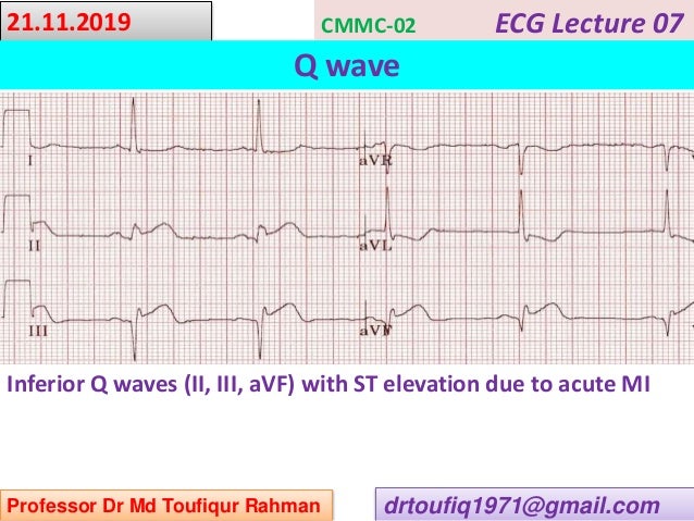 ECG-Q wave