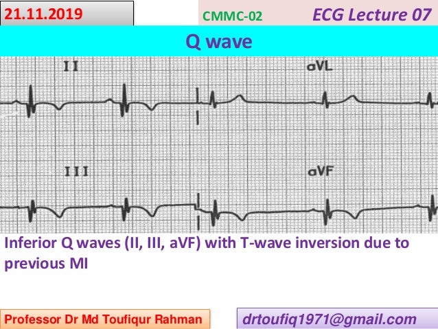 ECG-Q wave