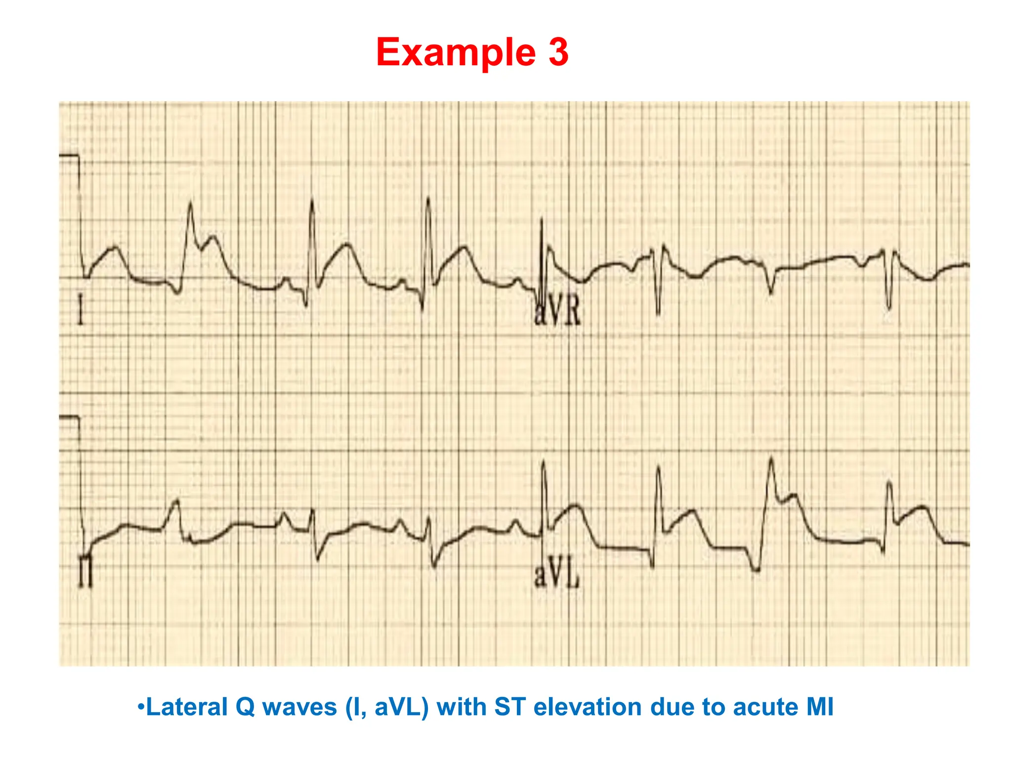 Q WAVE IN ECG,CAUSES OF PATHOLOGICAL Q WAVES | PPTX
