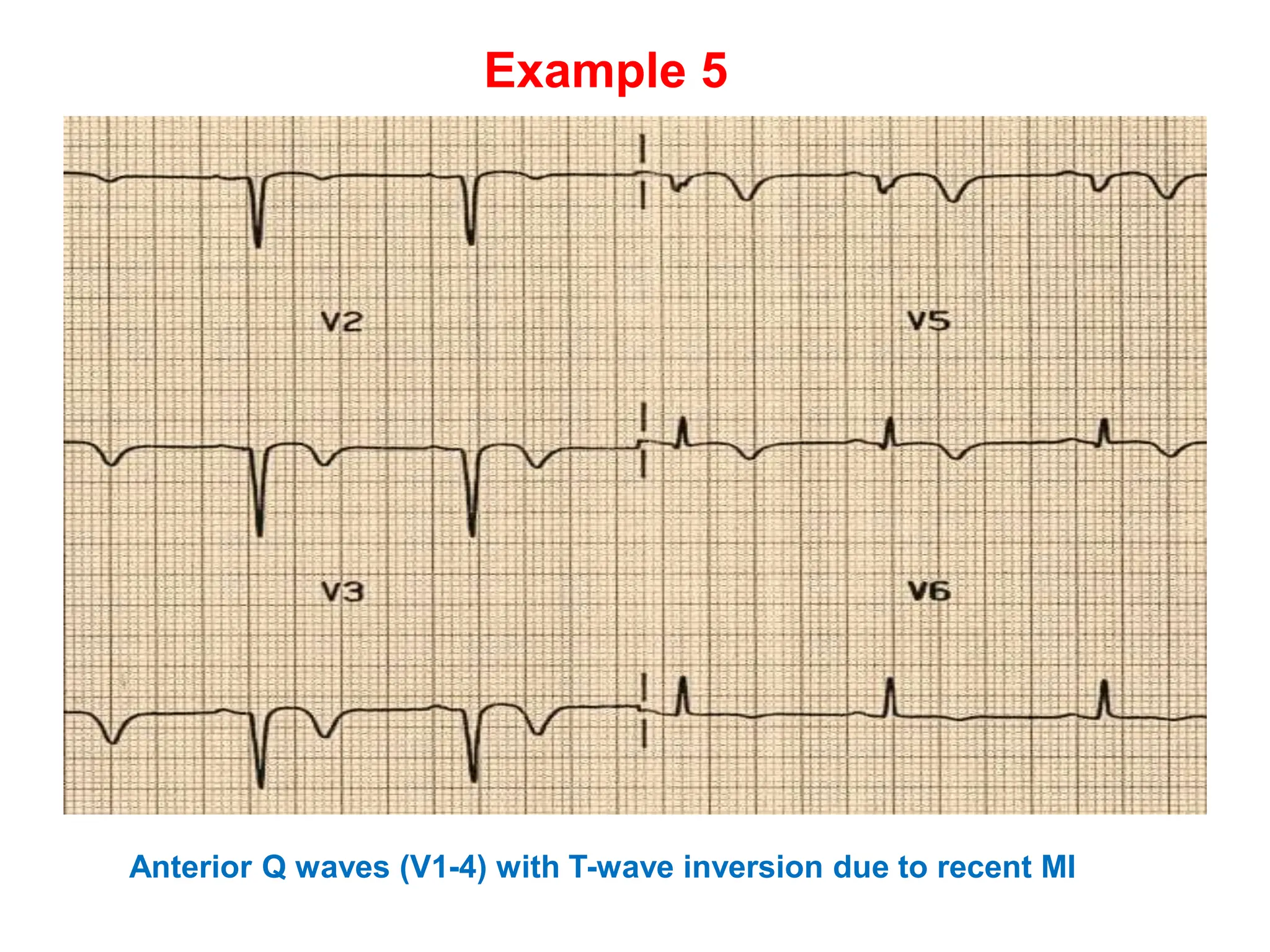 Q WAVE IN ECG,CAUSES OF PATHOLOGICAL Q WAVES | PPTX