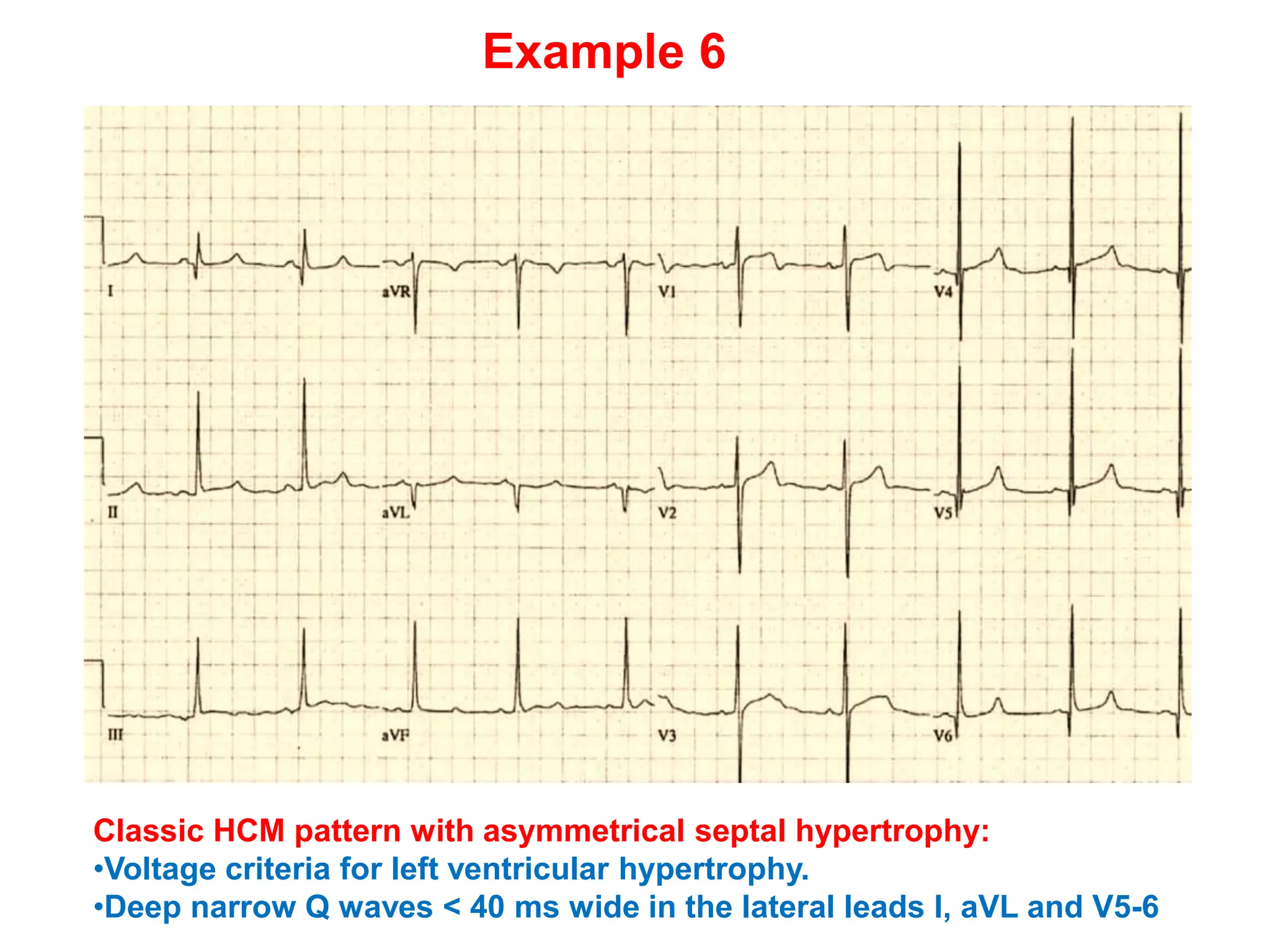 Q WAVE IN ECG,CAUSES OF PATHOLOGICAL Q WAVES | PPTX