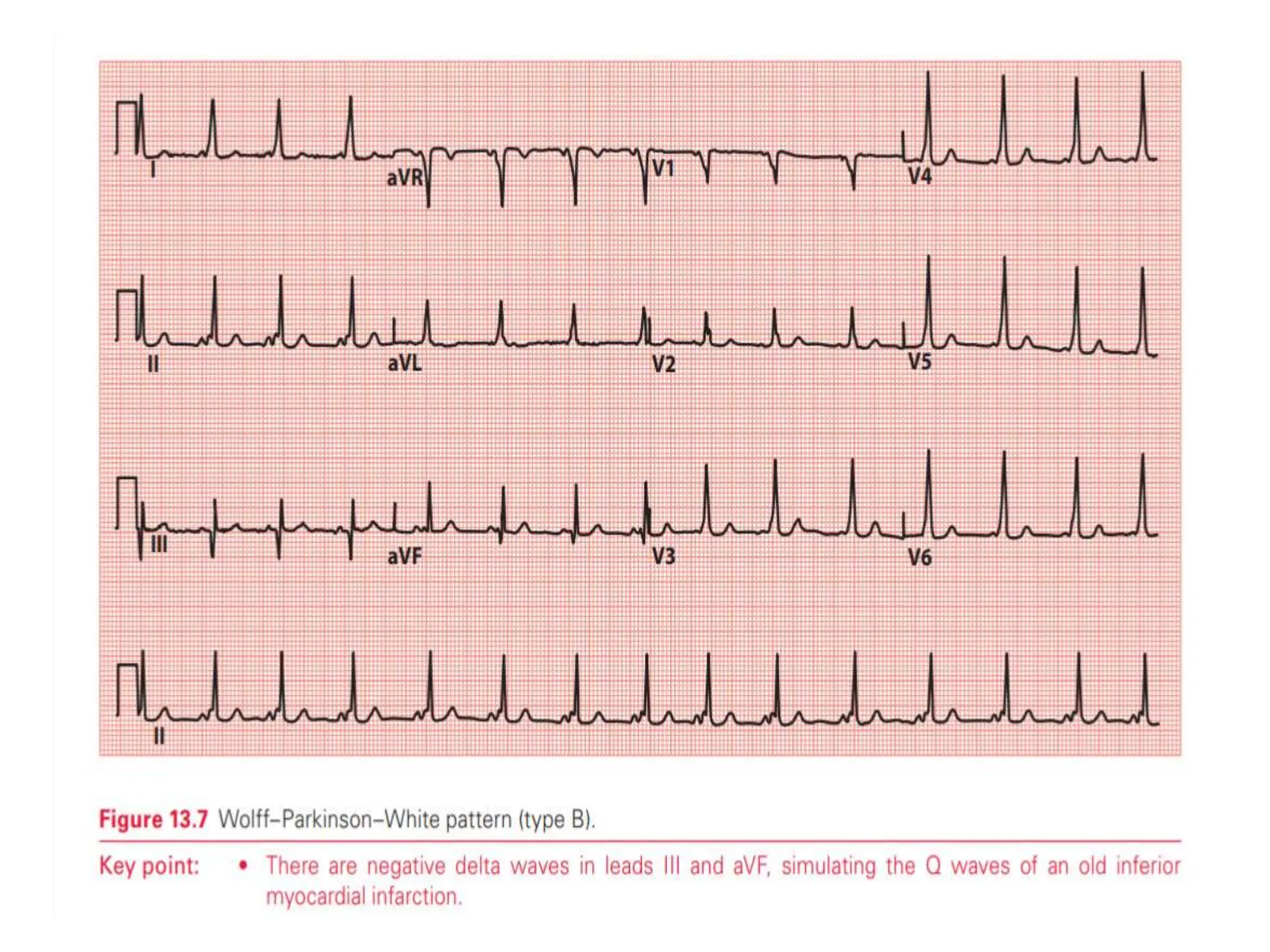 Q WAVE IN ECG,CAUSES OF PATHOLOGICAL Q WAVES | PPTX