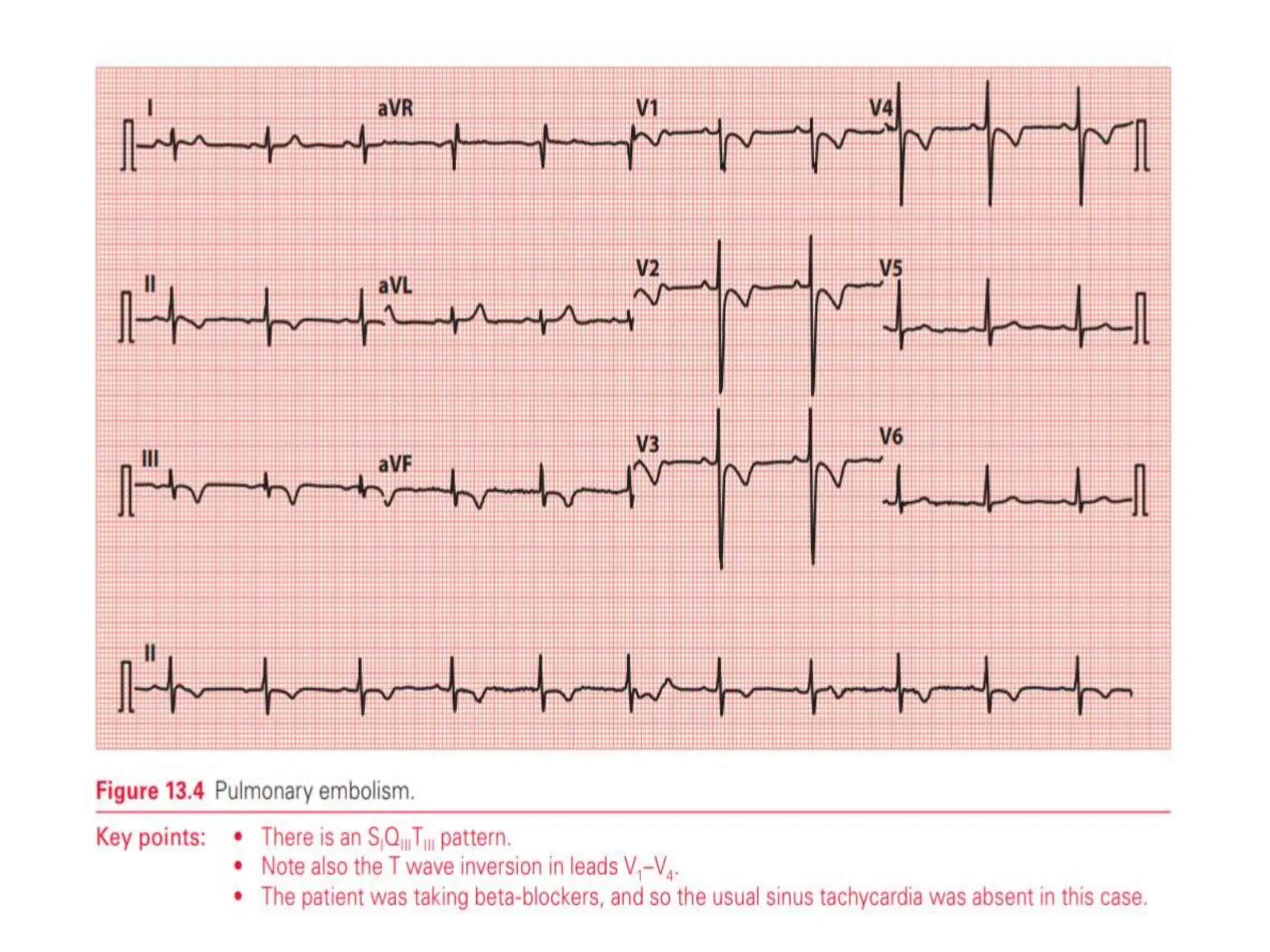 Q WAVE IN ECG,CAUSES OF PATHOLOGICAL Q WAVES | PPTX
