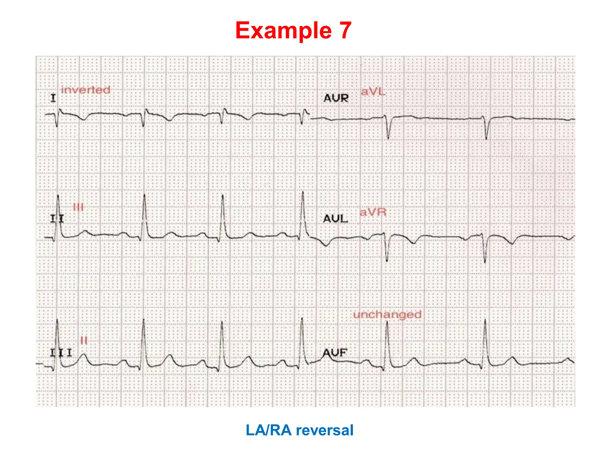 Q WAVE IN ECG,CAUSES OF PATHOLOGICAL Q WAVES | PPTX