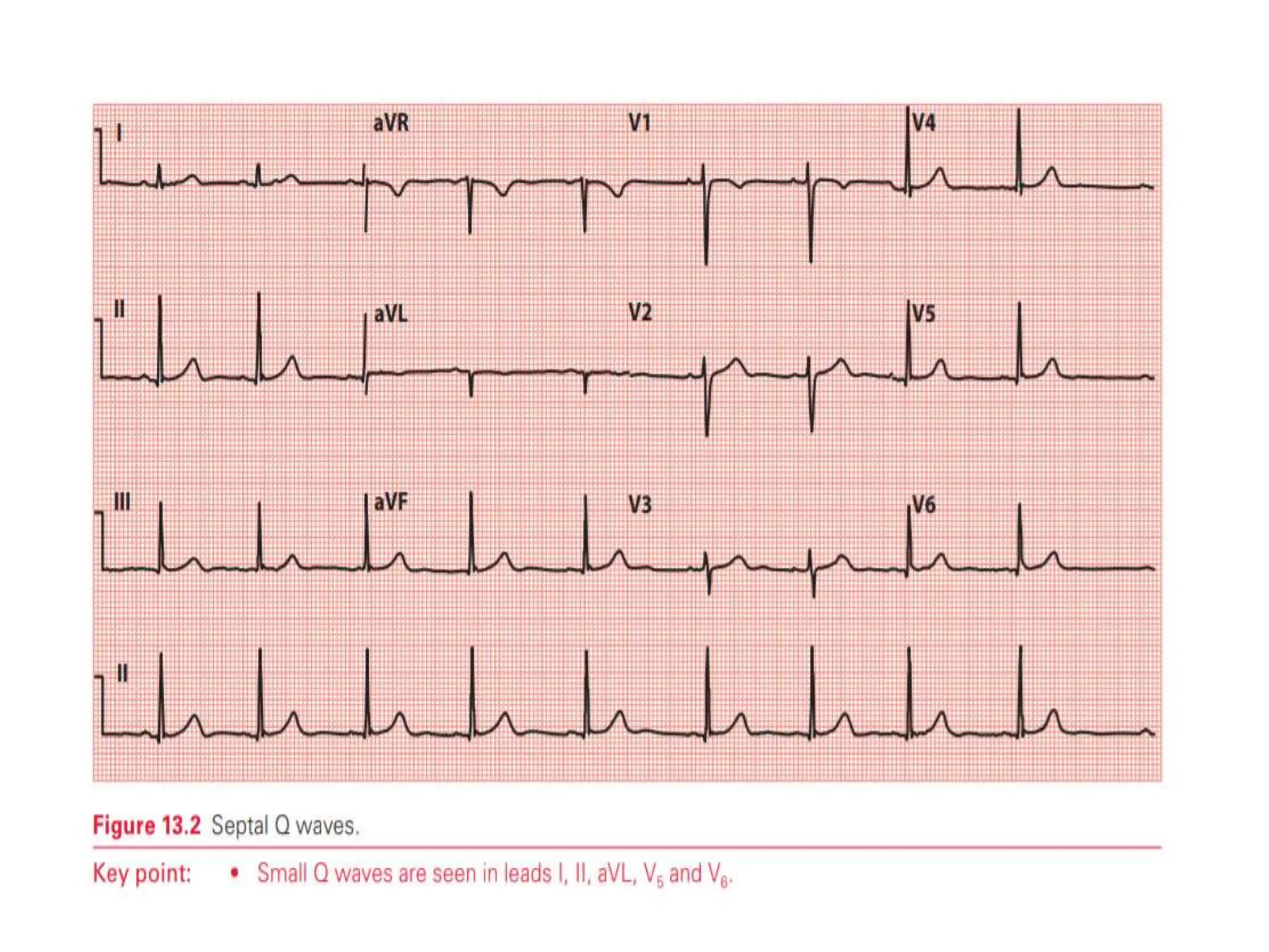 Q WAVE IN ECG,CAUSES OF PATHOLOGICAL Q WAVES | PPTX