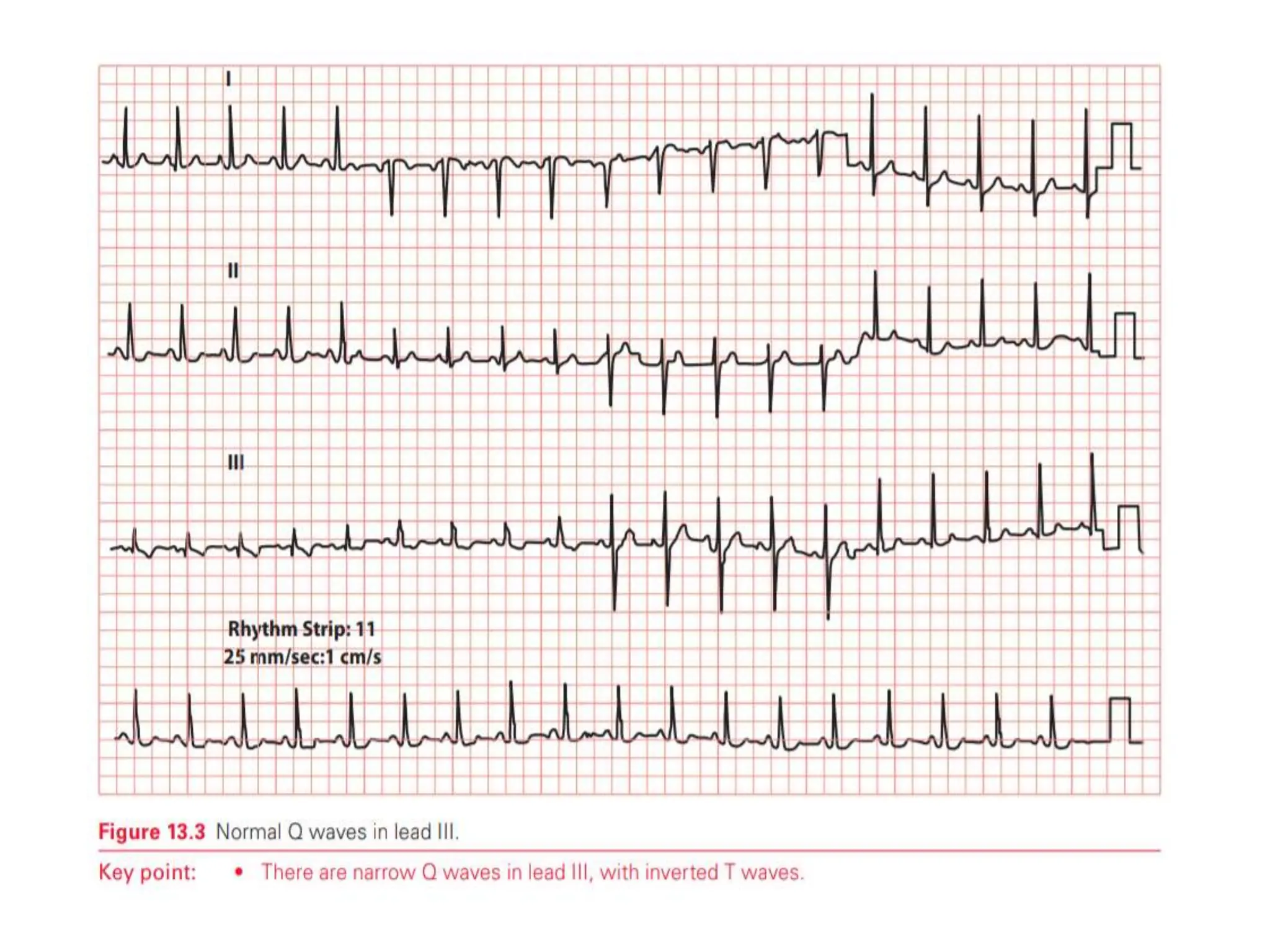 Q WAVE IN ECG,CAUSES OF PATHOLOGICAL Q WAVES | PPTX