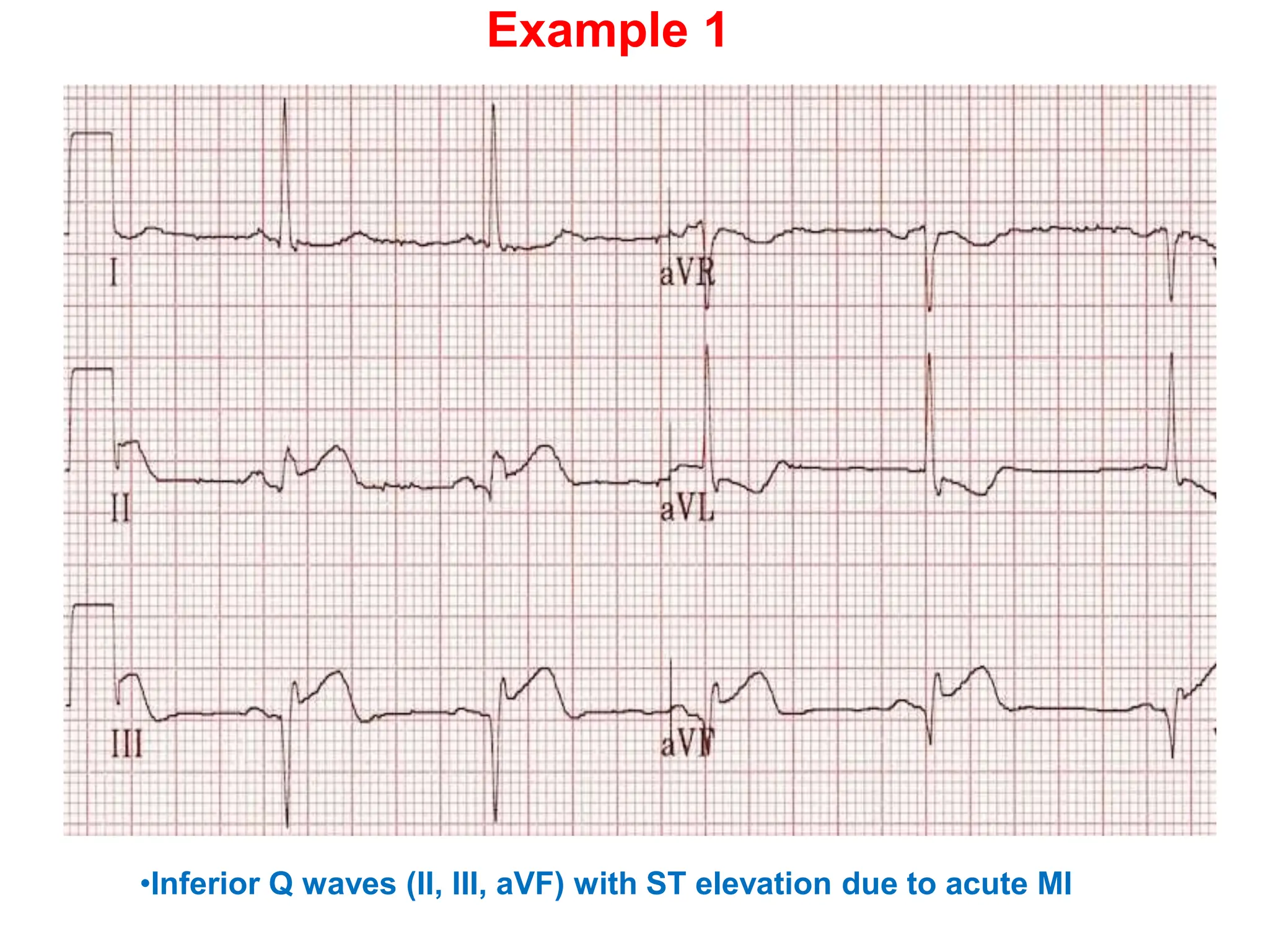 Q WAVE IN ECG,CAUSES OF PATHOLOGICAL Q WAVES | PPTX