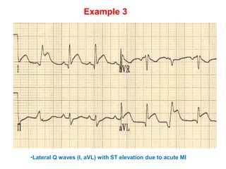 Q WAVE IN ECG,CAUSES OF PATHOLOGICAL Q WAVES | PPTX