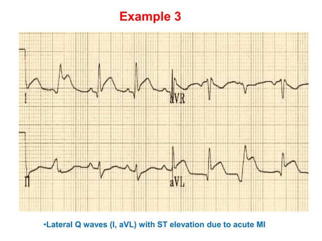 Q WAVE IN ECG,CAUSES OF PATHOLOGICAL Q WAVES | PPTX | Heart and ...