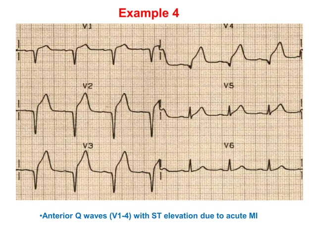 Q WAVE IN ECG,CAUSES OF PATHOLOGICAL Q WAVES | PPTX | Heart and ...