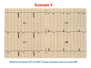 Q WAVE IN ECG,CAUSES OF PATHOLOGICAL Q WAVES | PPTX | Heart and ...
