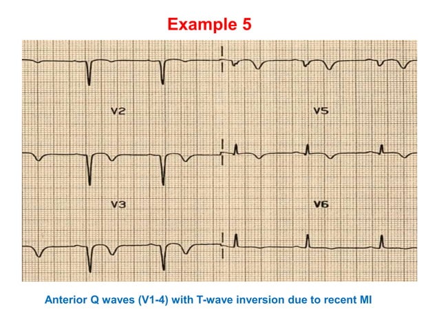 Q WAVE IN ECG,CAUSES OF PATHOLOGICAL Q WAVES | PPTX | Heart and ...