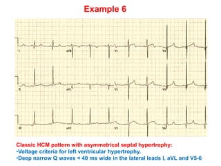 Q WAVE IN ECG,CAUSES OF PATHOLOGICAL Q WAVES | PPTX