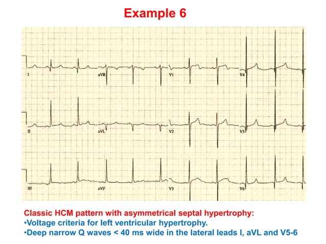 Q WAVE IN ECG,CAUSES OF PATHOLOGICAL Q WAVES | PPTX | Heart and ...