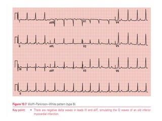 Q WAVE IN ECG,CAUSES OF PATHOLOGICAL Q WAVES | PPTX