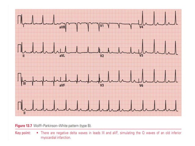 Q WAVE IN ECG,CAUSES OF PATHOLOGICAL Q WAVES | PPTX | Heart and ...