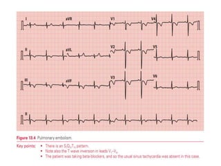 Q WAVE IN ECG,CAUSES OF PATHOLOGICAL Q WAVES | PPTX