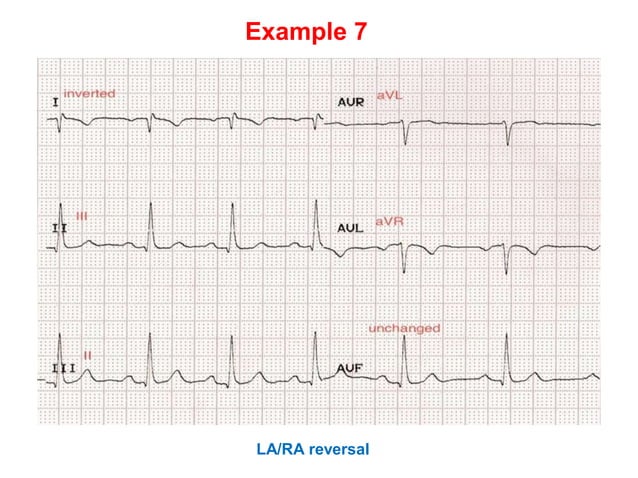 Q WAVE IN ECG,CAUSES OF PATHOLOGICAL Q WAVES | PPTX | Heart and ...