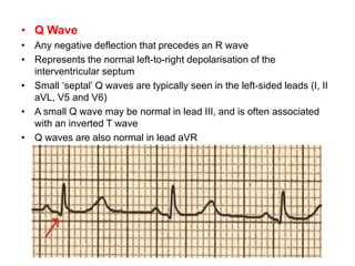 Q WAVE IN ECG,CAUSES OF PATHOLOGICAL Q WAVES | PPTX