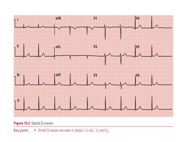 Q WAVE IN ECG,CAUSES OF PATHOLOGICAL Q WAVES | PPTX | Heart and ...