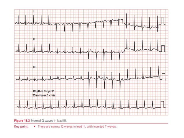 Q WAVE IN ECG,CAUSES OF PATHOLOGICAL Q WAVES | PPTX | Heart and ...
