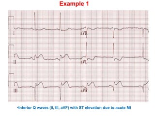 Q WAVE IN ECG,CAUSES OF PATHOLOGICAL Q WAVES | PPTX