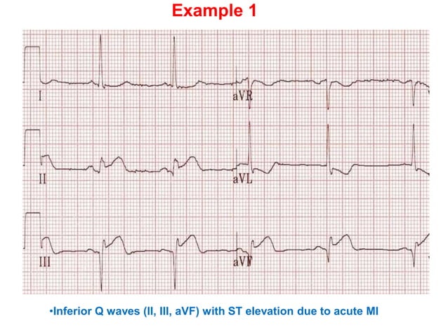 Q WAVE IN ECG,CAUSES OF PATHOLOGICAL Q WAVES | PPTX | Heart and ...