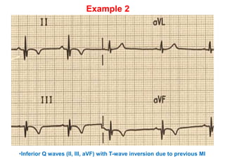 Q WAVE IN ECG,CAUSES OF PATHOLOGICAL Q WAVES | PPTX
