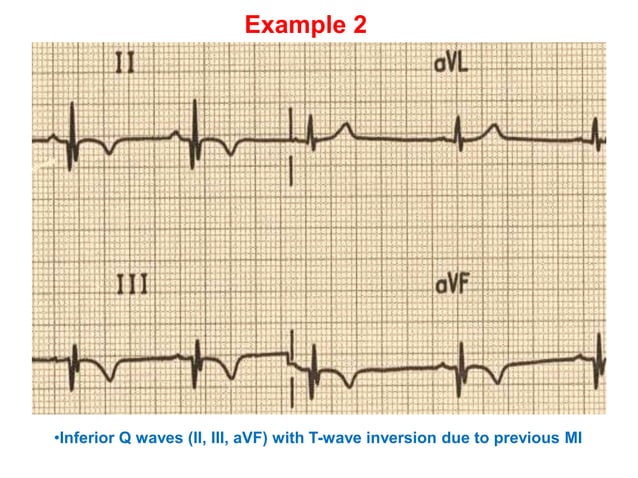 Q WAVE IN ECG,CAUSES OF PATHOLOGICAL Q WAVES | PPTX | Heart and ...