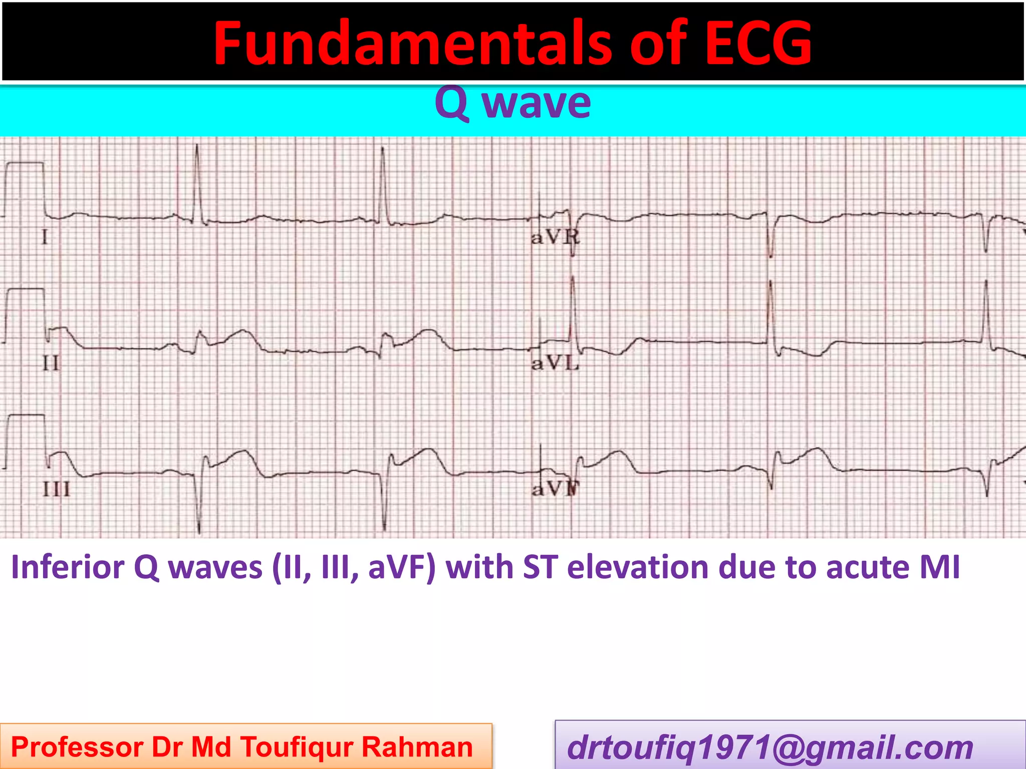 Approach to a patient with Q wave abnormality in ECG | PPSX