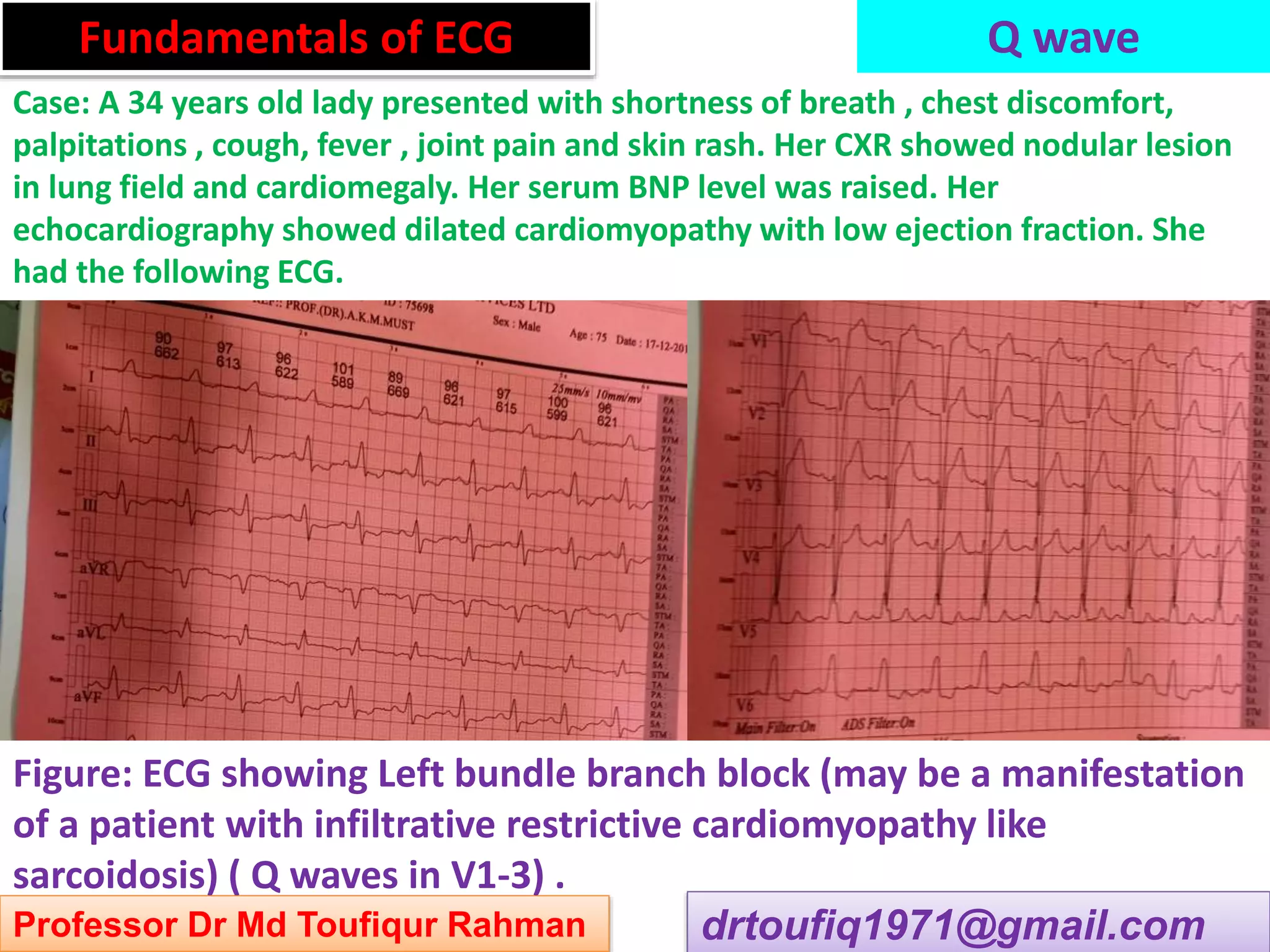 Approach to a patient with Q wave abnormality in ECG | PPSX
