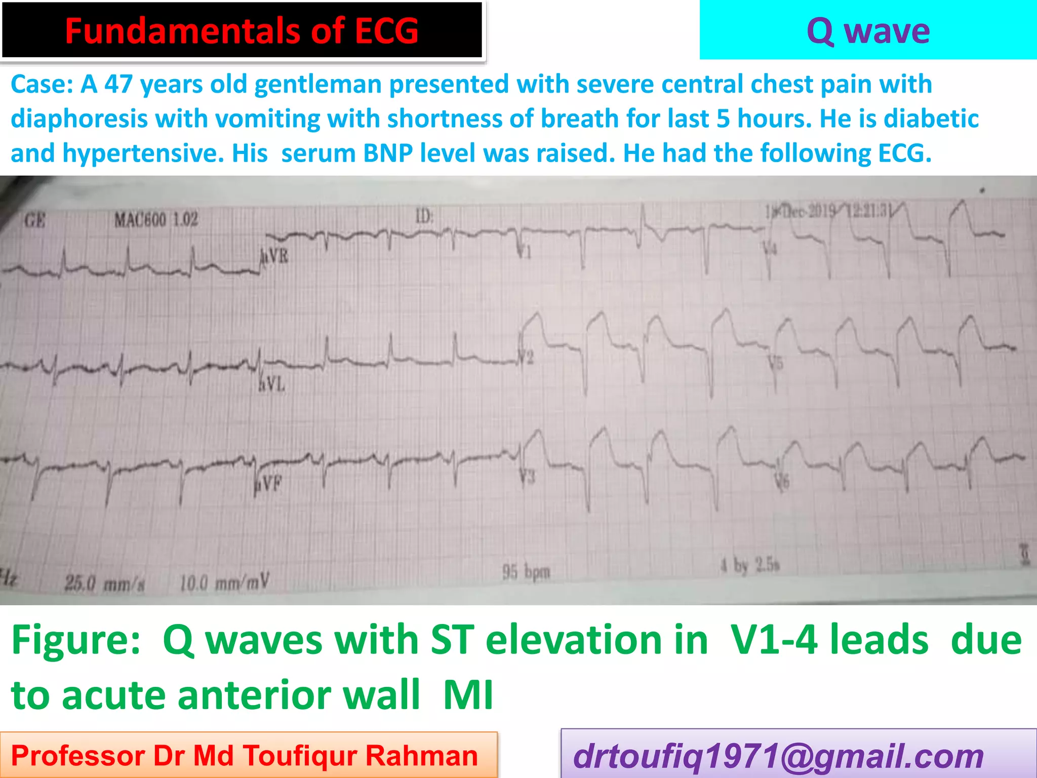 Approach to a patient with Q wave abnormality in ECG | PPSX