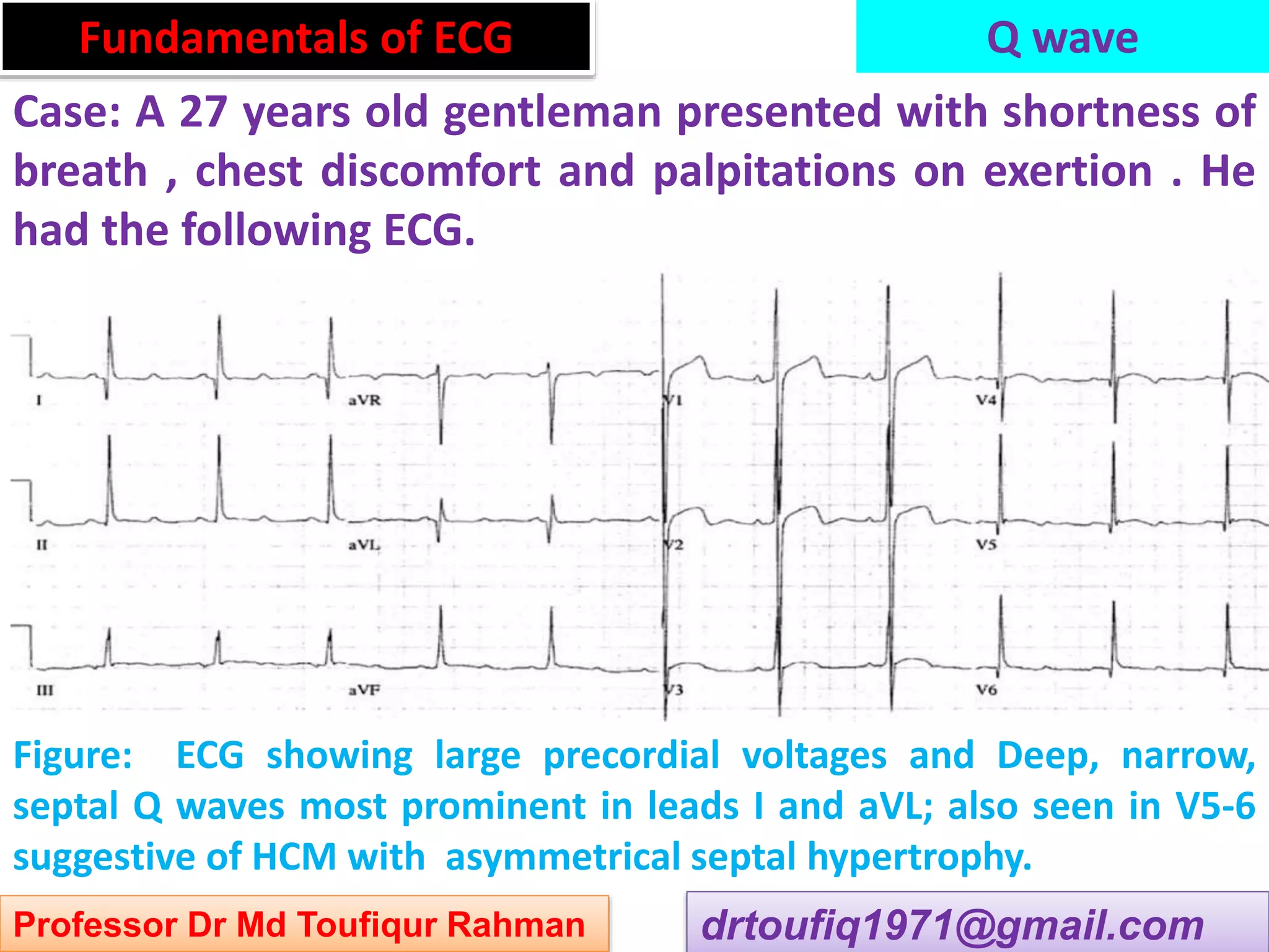 Approach to a patient with Q wave abnormality in ECG | PPSX